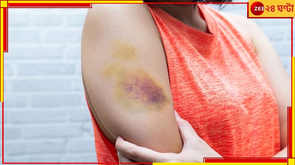 Bruise Mark: সাবধান! আঘাত ছাড়াই কালশিটে আভাস দিচ্ছে বড় রোগের ...