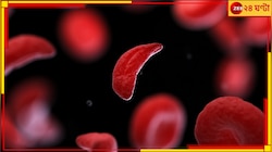 sickle cell anemia News in Bengali, Latest sickle cell anemia Bangla ...