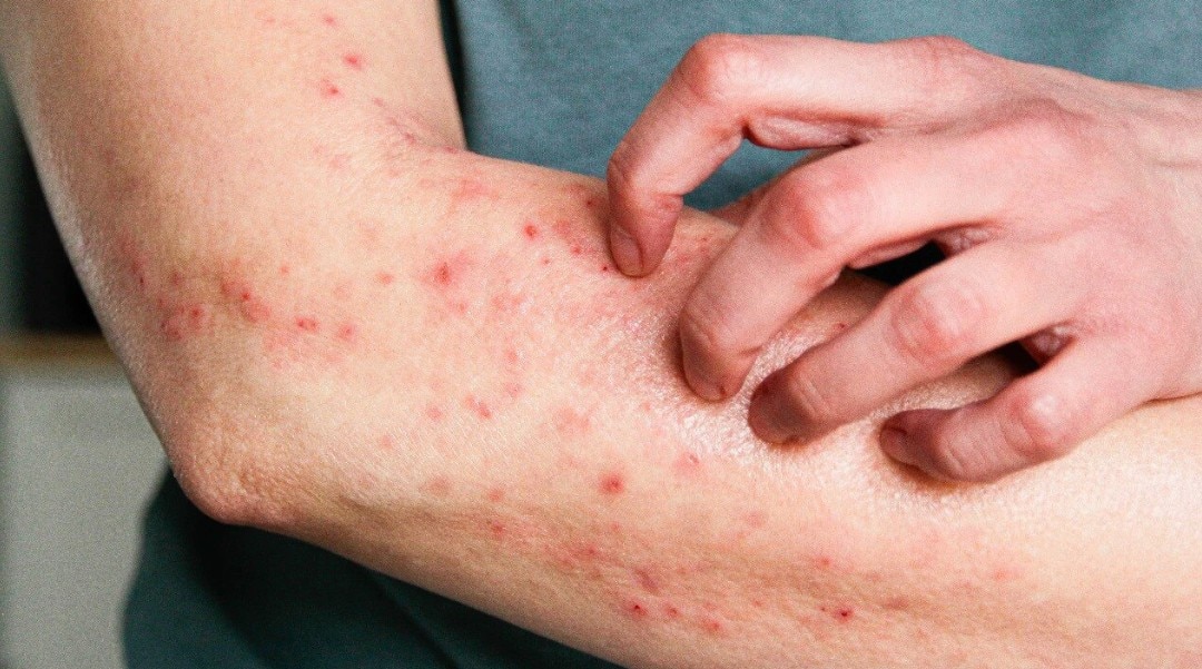 Deadly Fungal Infection: মৃত্যুমুখে পড়তে পারেন ১০ লাখ! শরীরে বাসা ...